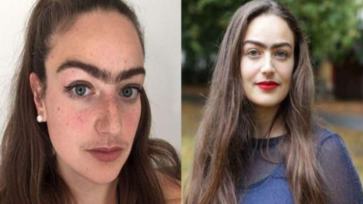 Η 31χρονη που σταμάτησε να βγάζει φρύδια και μουστάκι γιατί νιώθει ...