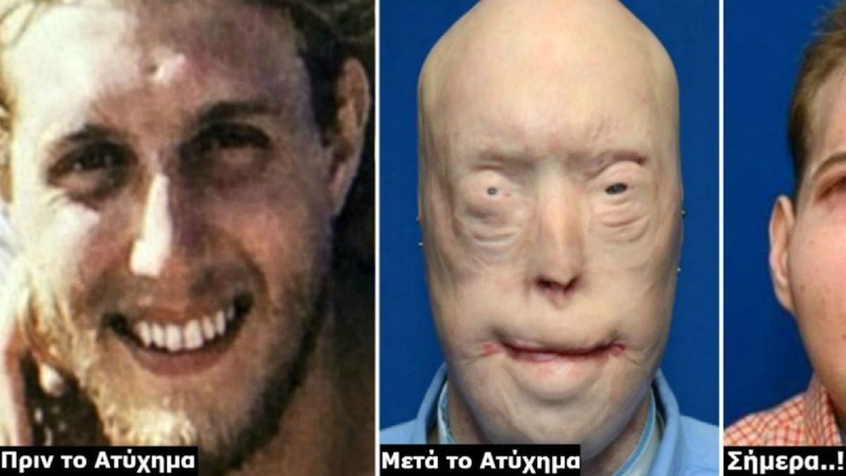 Θυμάστε τον πυροσβέστη που είχε κάψει ολοσχερώς το πρόσωπό του εν ώρα ...